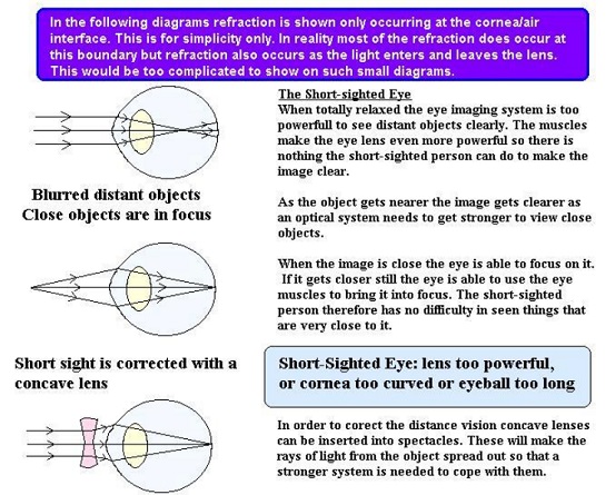 what is hyperopia |Myopia and Hyperopia | Physics Wallah