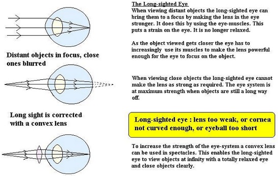 what is hyperopia |Myopia and Hyperopia | Physics Wallah