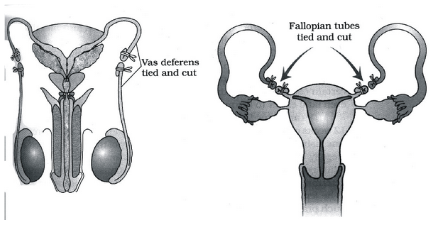 surgical-methods-of-family-planning